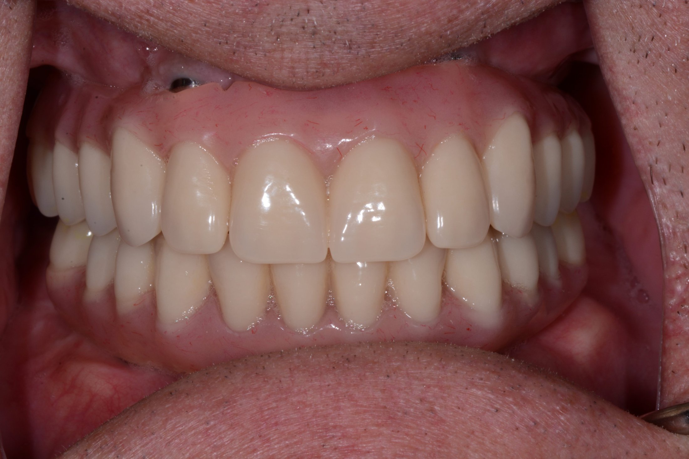Before & After Dental Implants | Rockford Oral & Maxillofacial Surgery