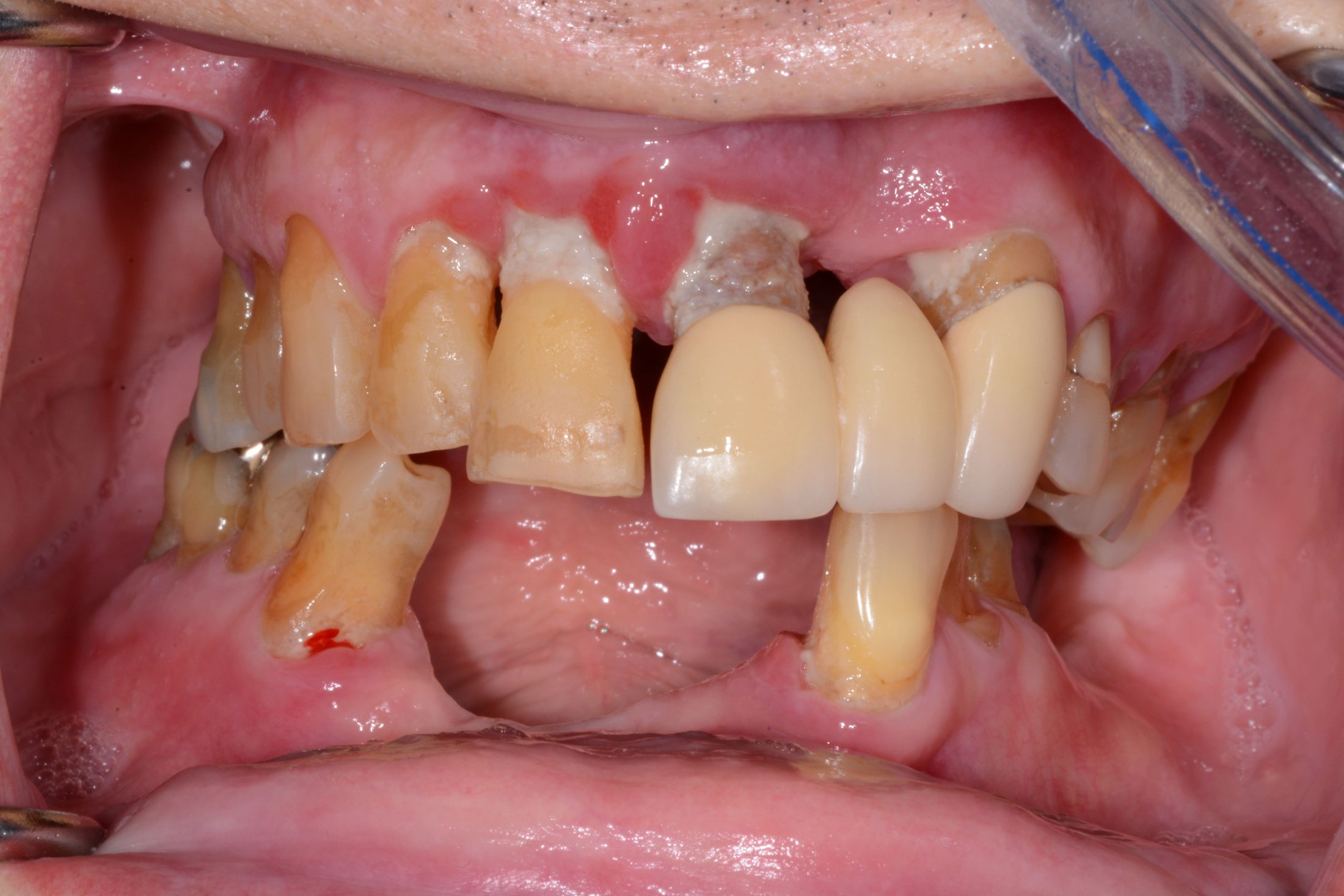 Before & After Dental Implants | Rockford Oral & Maxillofacial Surgery